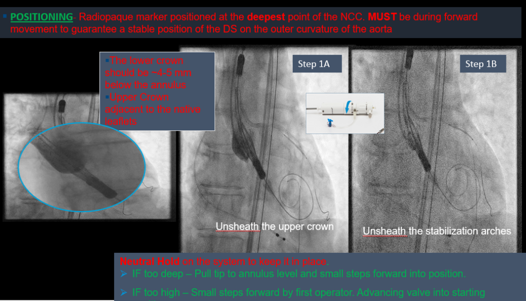 Dr Dhamodaran K | Best cardiologist for TAVR/TAVI In Chennai | Best ...